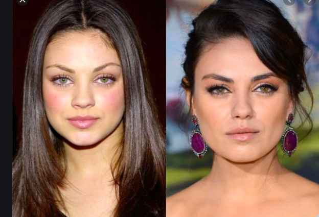 Bolas de Bichat - Bichectomía - Antes y Después