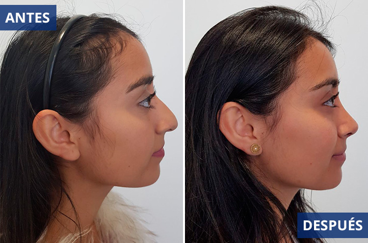 Operación Nariz Ancha - Rinoplastia - Antes y Después
